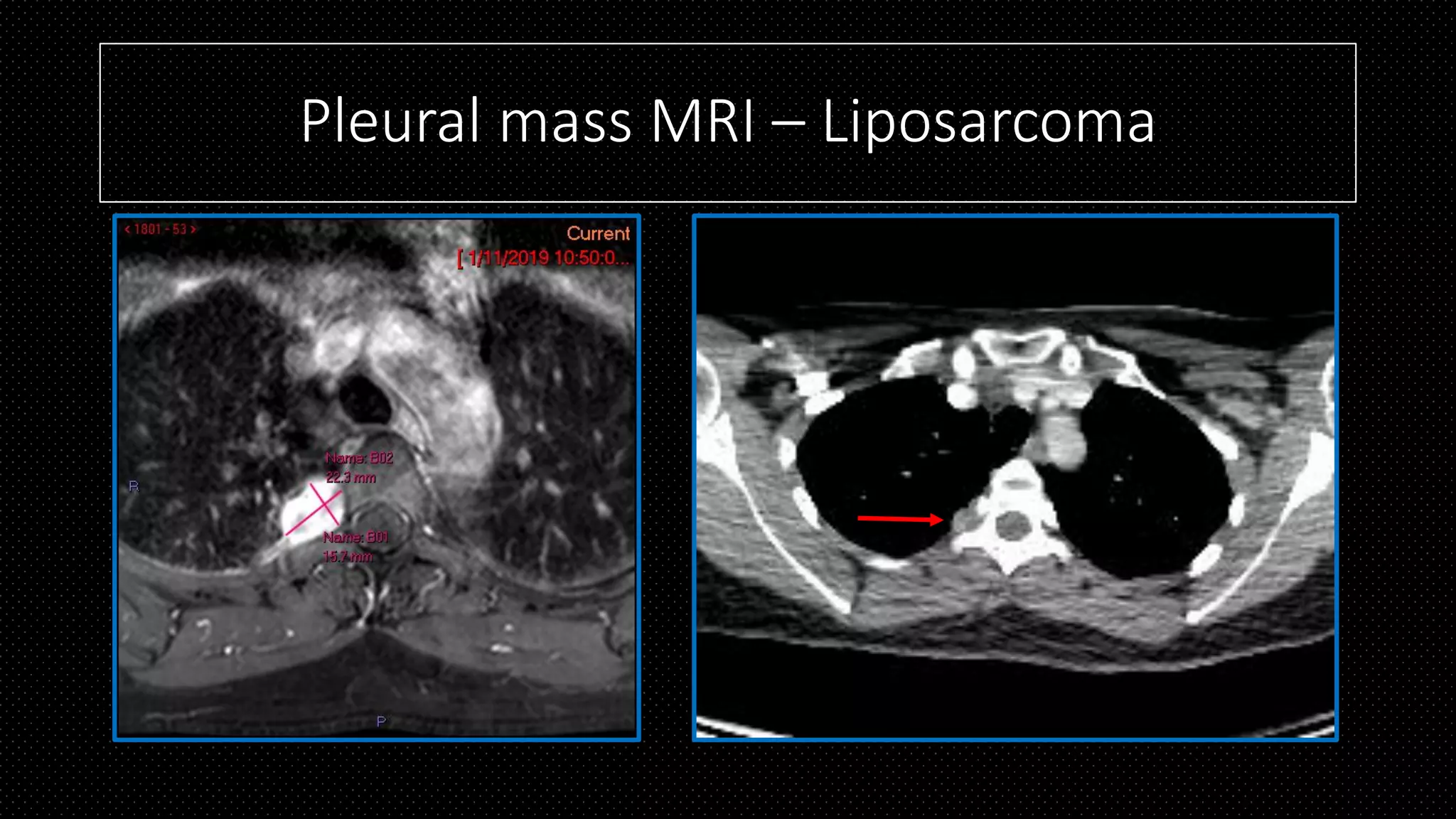02 pleural disease 2019 radiology | PDF