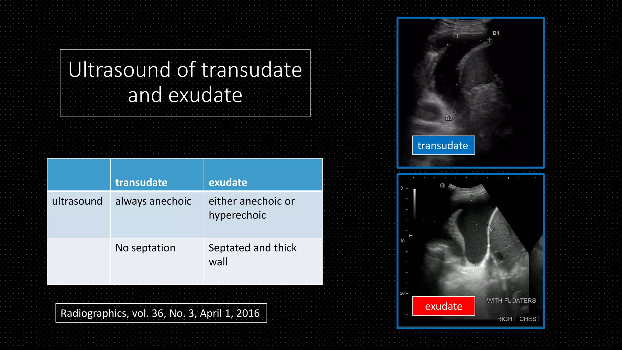 02 pleural disease 2019 radiology | PDF