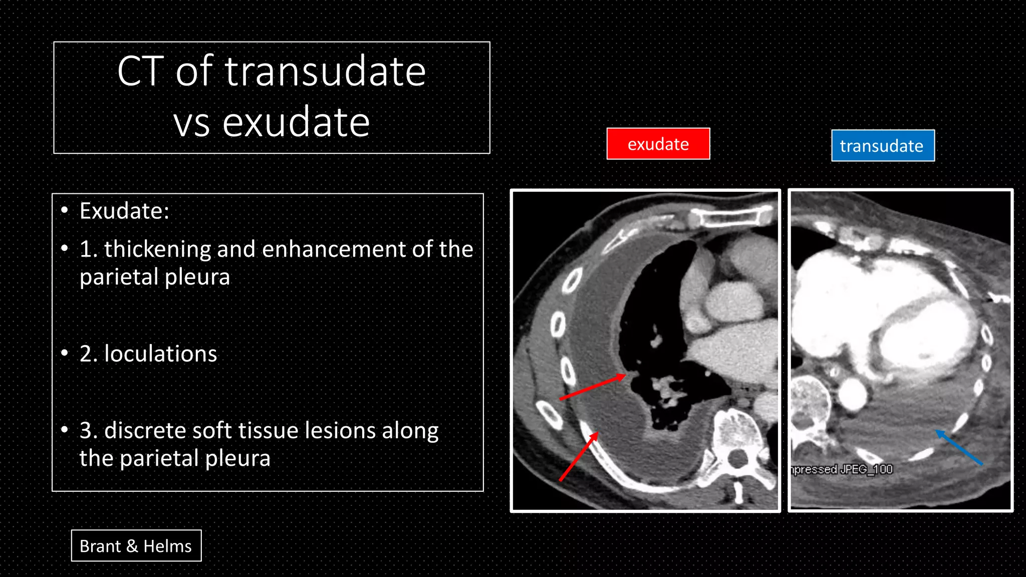02 pleural disease 2019 radiology | PDF