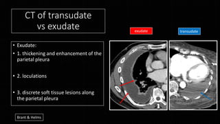 02 pleural disease 2019 radiology | PDF