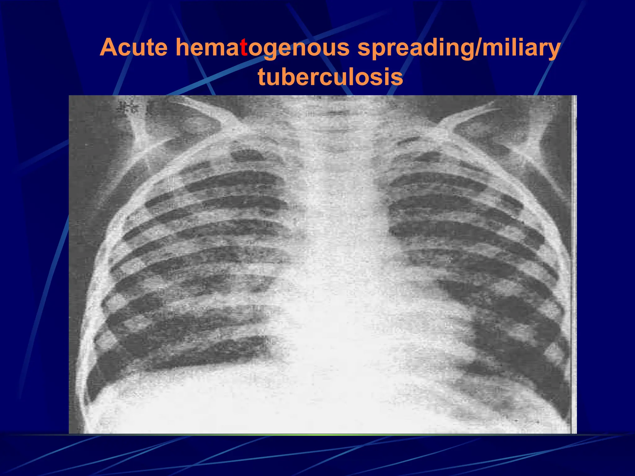 Pulmonary Tuberculosis and its presentationss.ppt