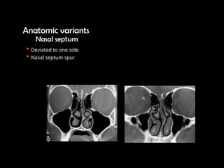 02 Radiology of nose and pns.PPT Dr alakwa amran | PPT