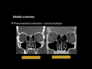 02 Radiology of nose and pns.PPT Dr alakwa amran | PPT