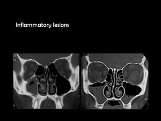 02 Radiology of nose and pns.PPT Dr alakwa amran | PPT