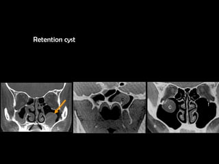 02 Radiology of nose and pns.PPT Dr alakwa amran | PPT