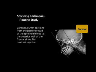 02 Radiology of nose and pns.PPT Dr alakwa amran | PPT