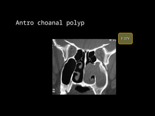02 Radiology of nose and pns.PPT Dr alakwa amran | PPT