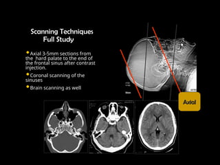 02 Radiology of nose and pns.PPT Dr alakwa amran | PPT