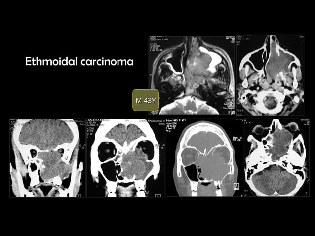 02 Radiology of nose and pns.PPT Dr alakwa amran | PPT