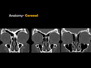 02 Radiology of nose and pns.PPT Dr alakwa amran | PPT