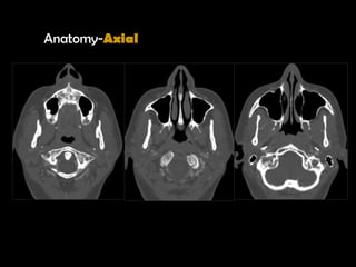 02 Radiology of nose and pns.PPT Dr alakwa amran | PPT