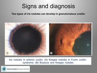 common eye disorder : uveitis ppt (infamation of uvea) | PPTX