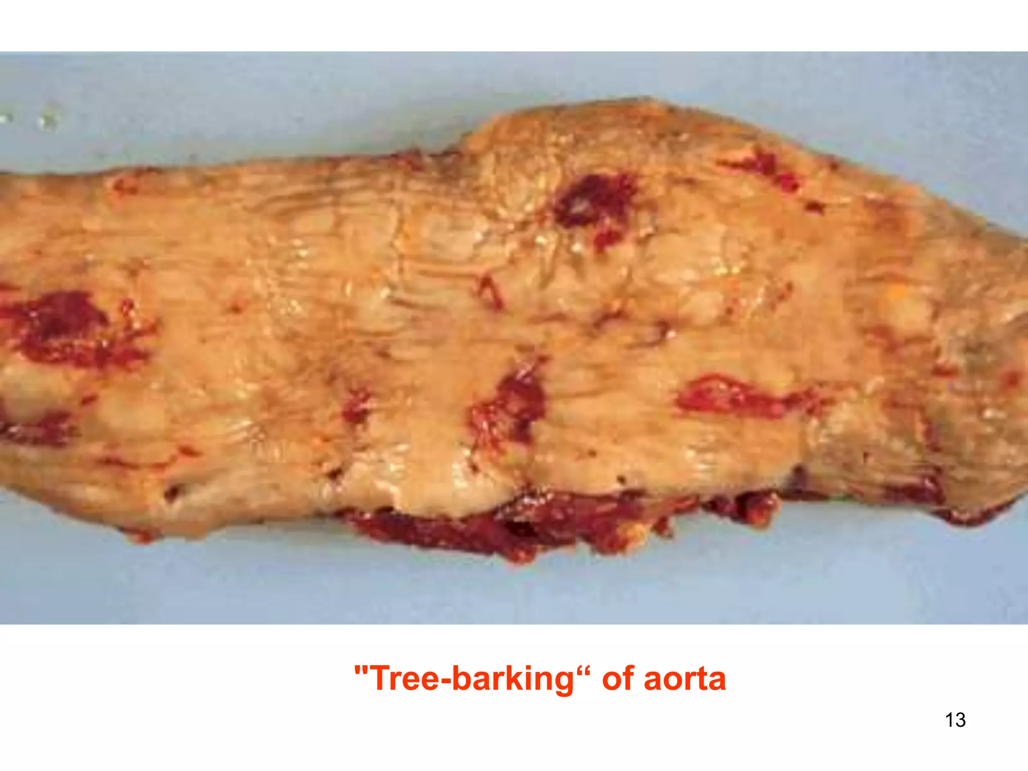 02 vascular pathology | PPT