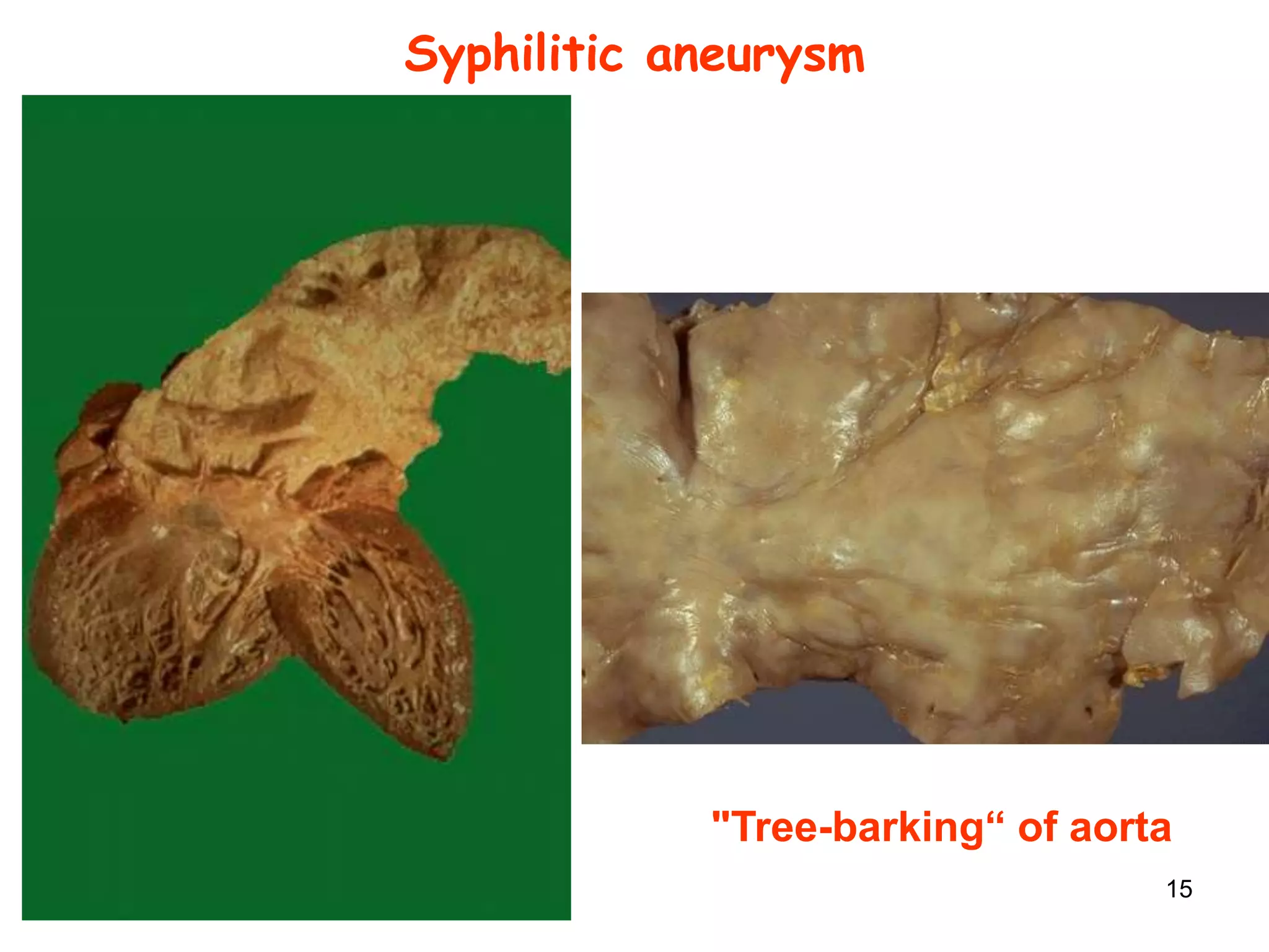 02 vascular pathology | PPT