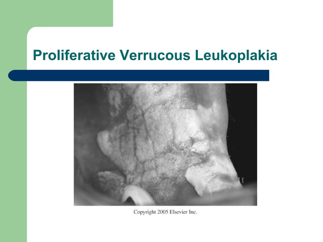 03 02-06 benign mucosal-lesions_of_the_oral_cavity1 | PPT