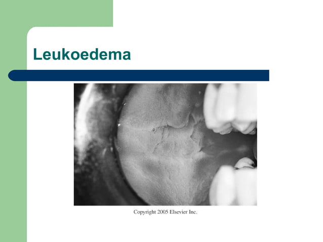 03 02-06 benign mucosal-lesions_of_the_oral_cavity1 | PPT