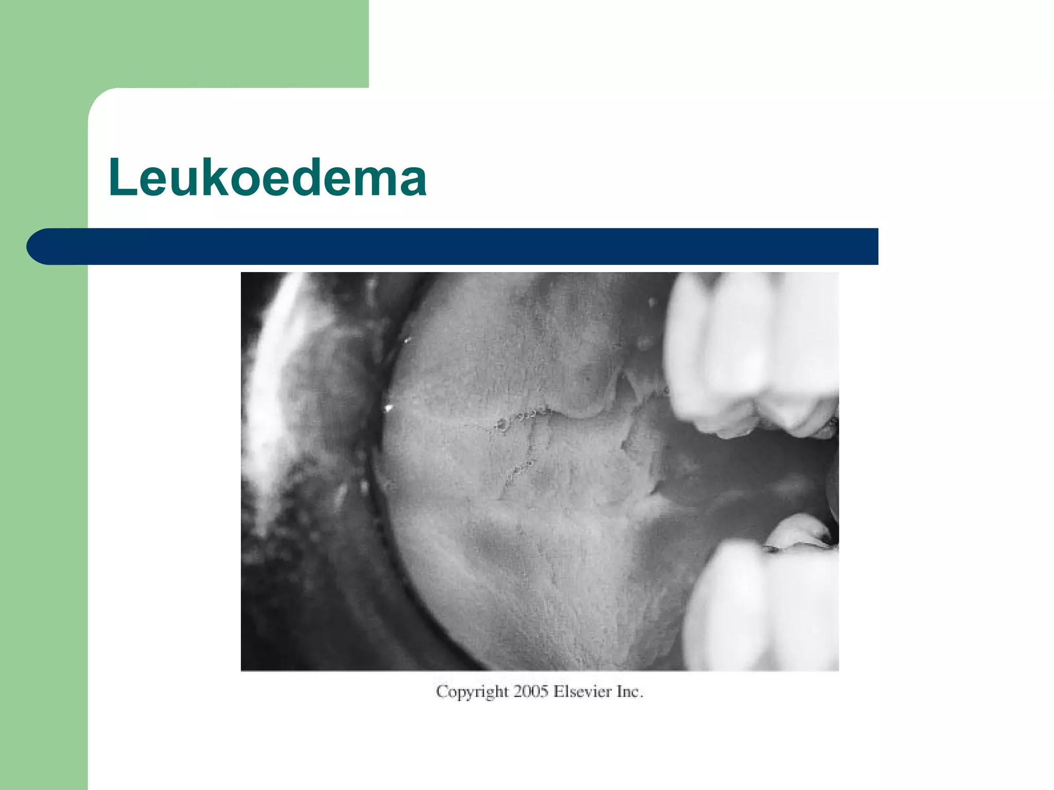 03 02-06 benign mucosal-lesions_of_the_oral_cavity1 | PPT