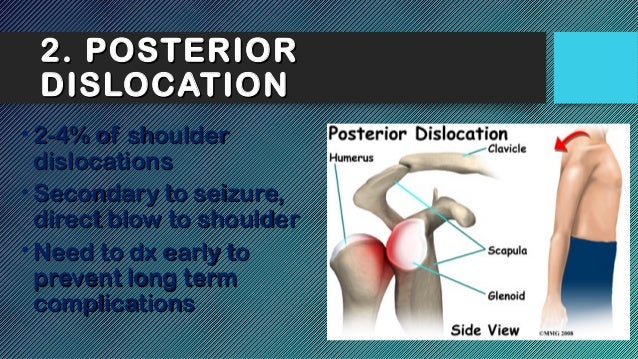 03. shoulder dislocation
