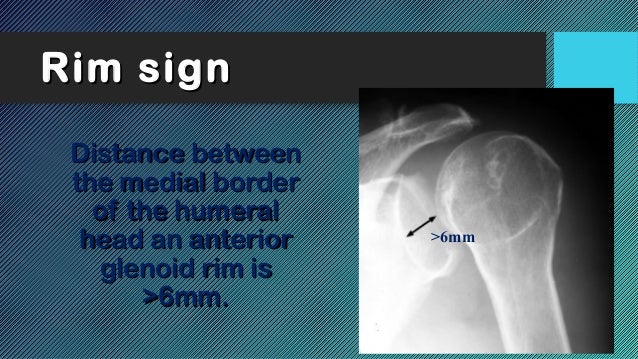 03. shoulder dislocation