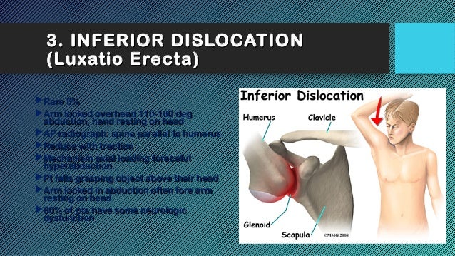 03. shoulder dislocation