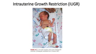 Oligohydramnios and IUGR | PPTX