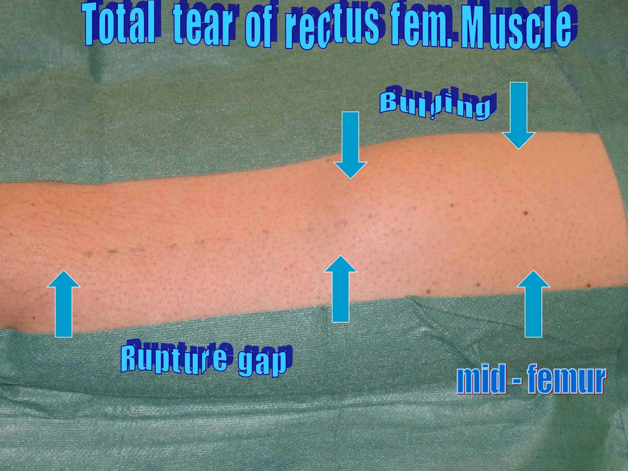 Rectus Femoris Injuries: what and when? Sakari Orava | PPT | Death ...