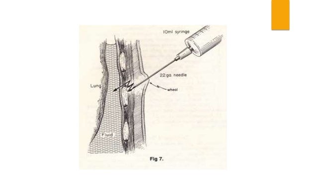 Puncion biopsia de pleura