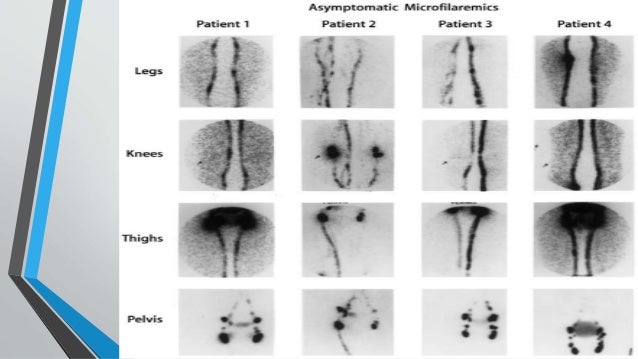 Nuclear Medicine - Lymphoscintigraphy