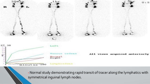 Nuclear Medicine - Lymphoscintigraphy