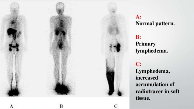 Nuclear Medicine - Lymphoscintigraphy