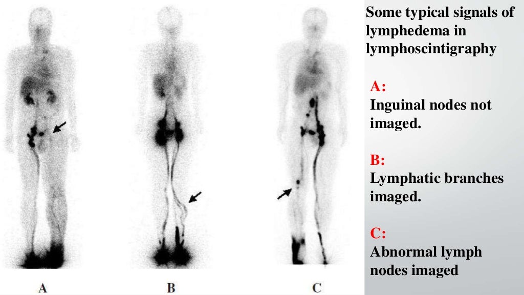 Nuclear Medicine - Lymphoscintigraphy