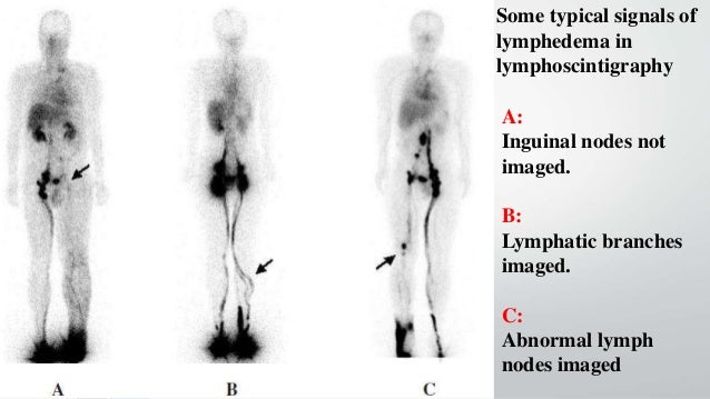 Nuclear Medicine - Lymphoscintigraphy