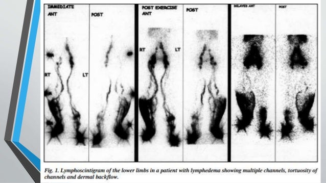 Nuclear Medicine - Lymphoscintigraphy