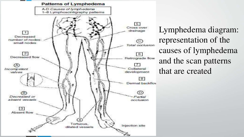 Nuclear Medicine - Lymphoscintigraphy