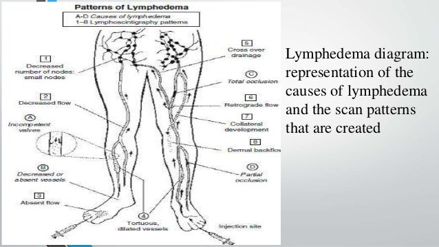 Nuclear Medicine - Lymphoscintigraphy