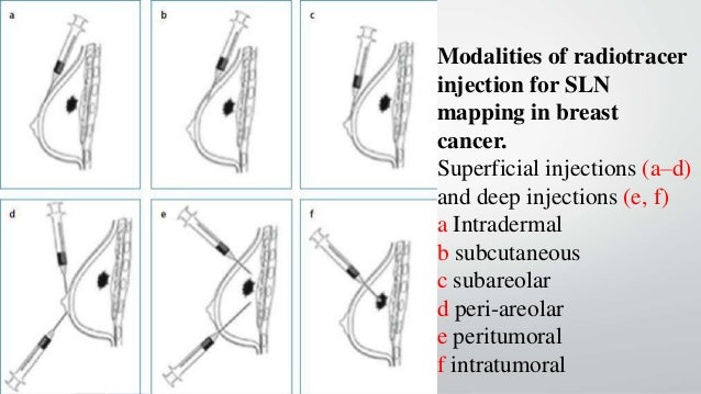Nuclear Medicine - Lymphoscintigraphy