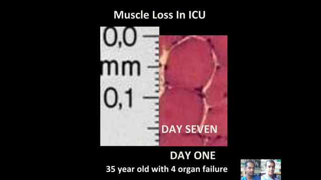 Muscle wasting in ICU: Fat, Feed and Futility | PPTX