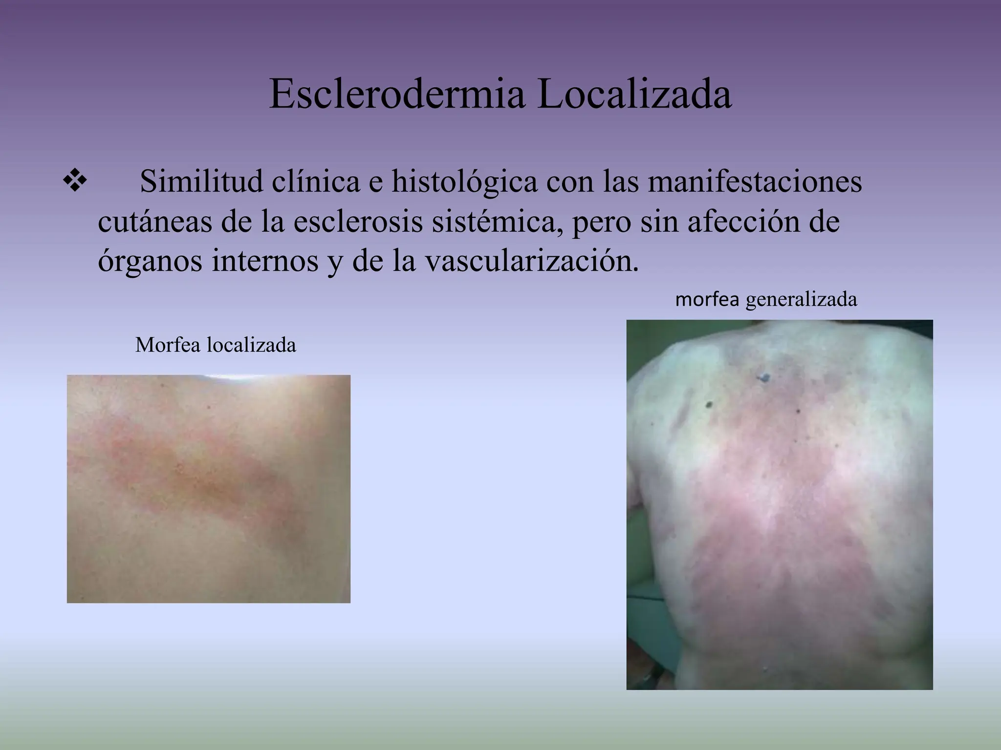 Esclerodermia, definicion, epidemiologia | PPTX