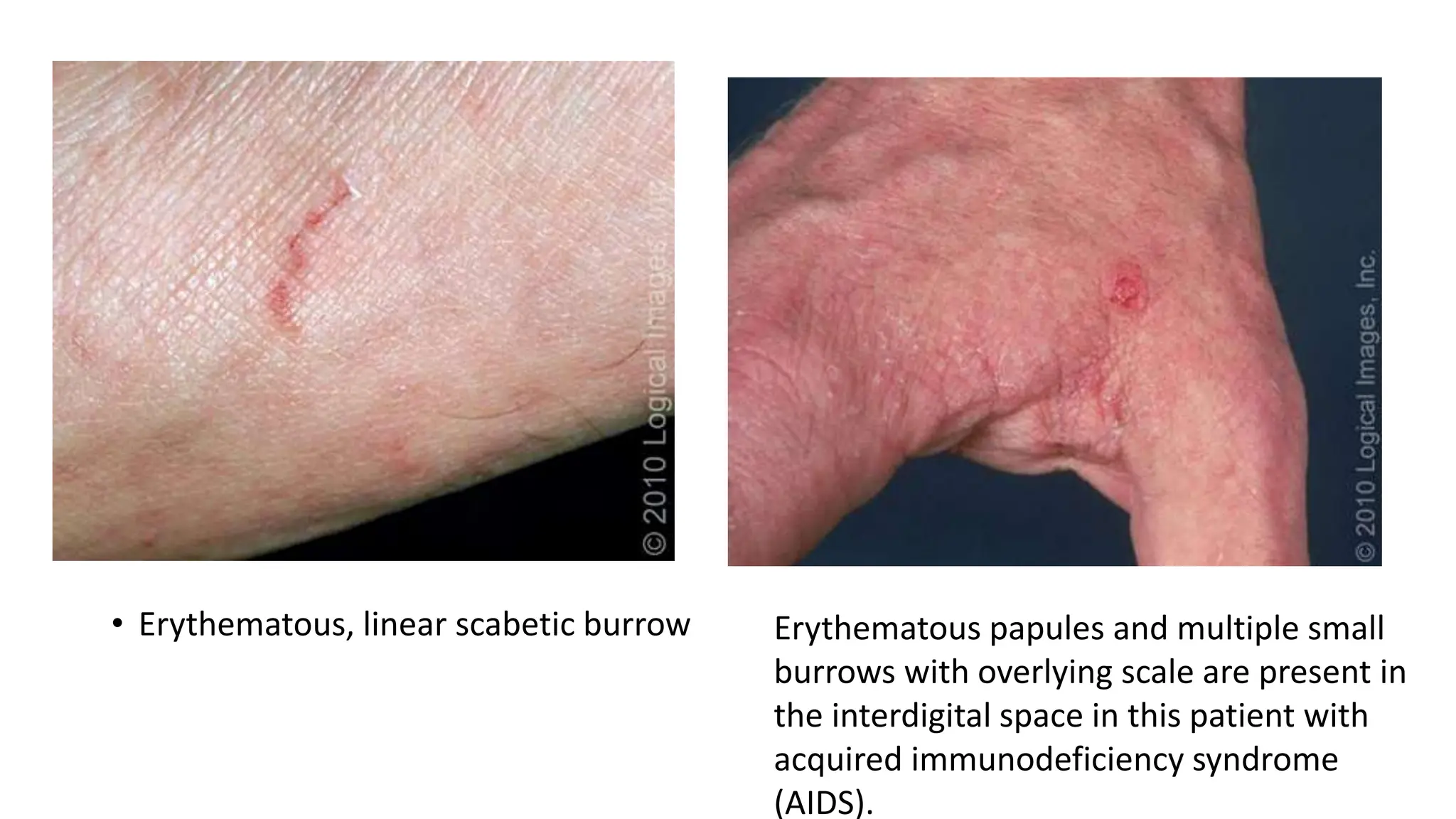 Scabies etiology, transmission, risk factors, clinical variants ...