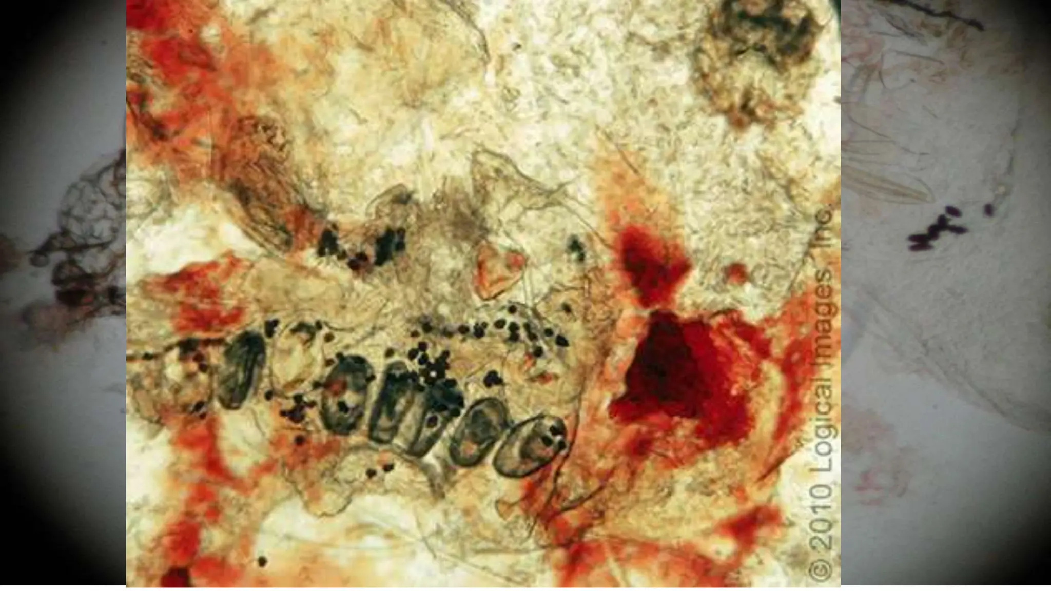 Scabies etiology, transmission, risk factors, clinical variants ...