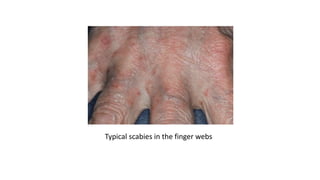 Scabies etiology, transmission, risk factors, clinical variants ...
