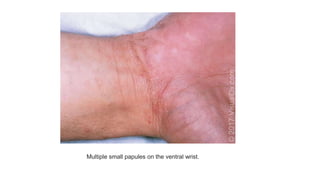Scabies etiology, transmission, risk factors, clinical variants ...