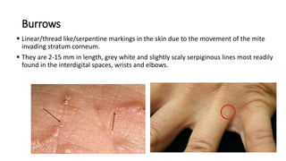 Scabies etiology, transmission, risk factors, clinical variants ...