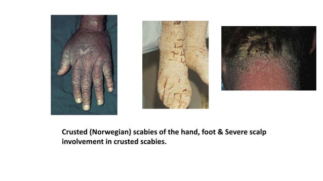 Scabies etiology, transmission, risk factors, clinical variants ...