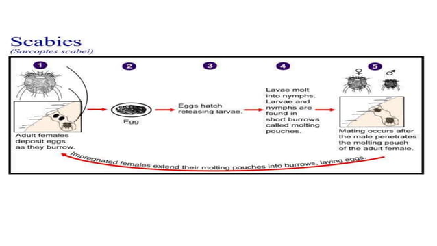 Scabies etiology, transmission, risk factors, clinical variants ...