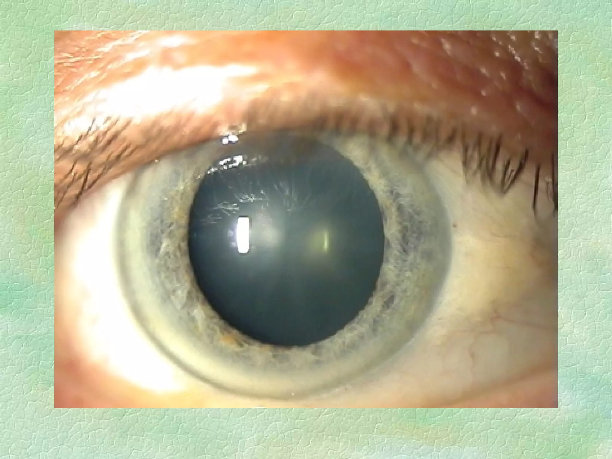 Eye health and vision standards for lifeguards | PPS