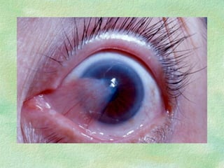 Eye health and vision standards for lifeguards | PPS