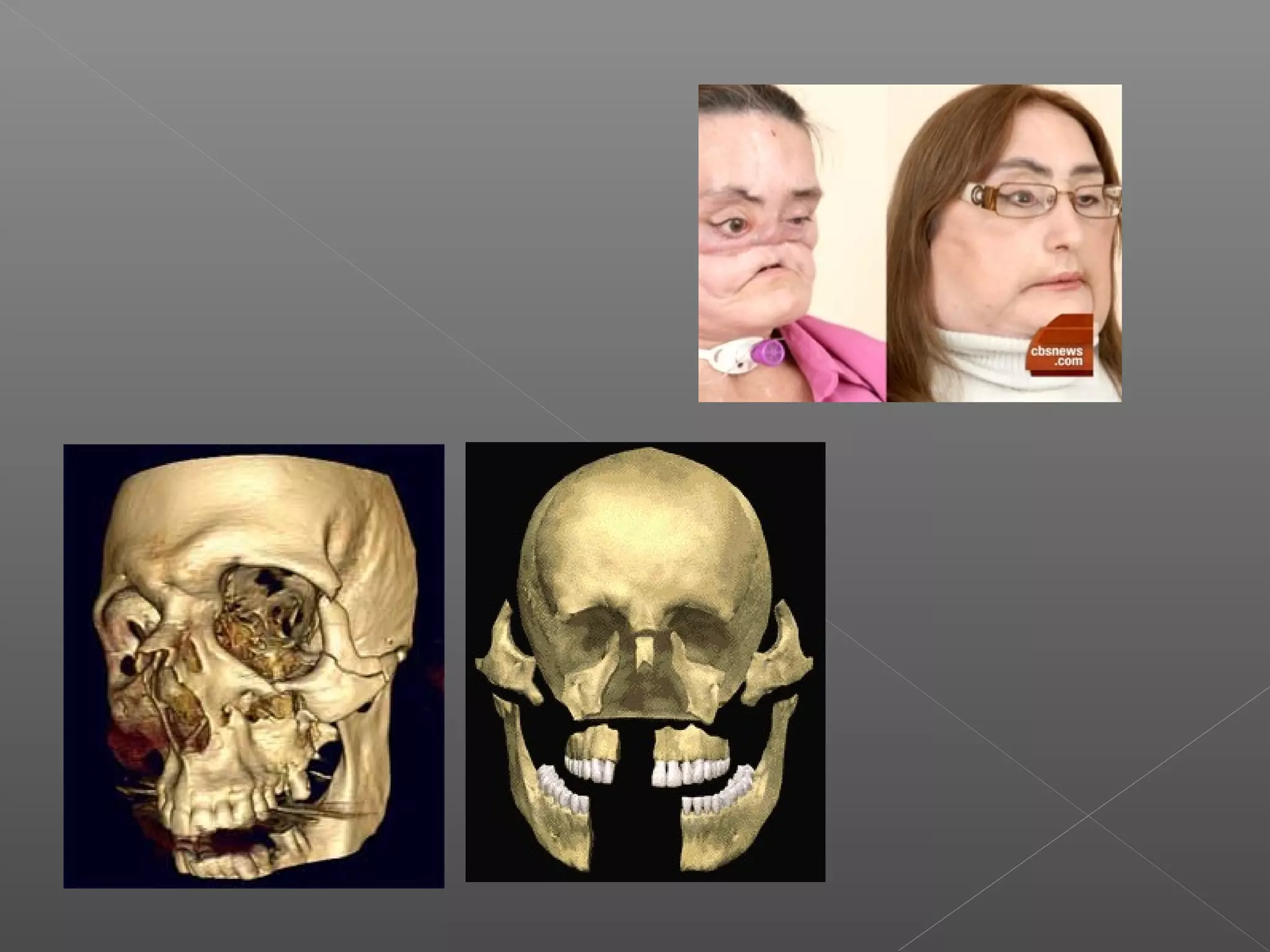 03 anaesthetic considerations in maxillofacial trauma surgery | PPT