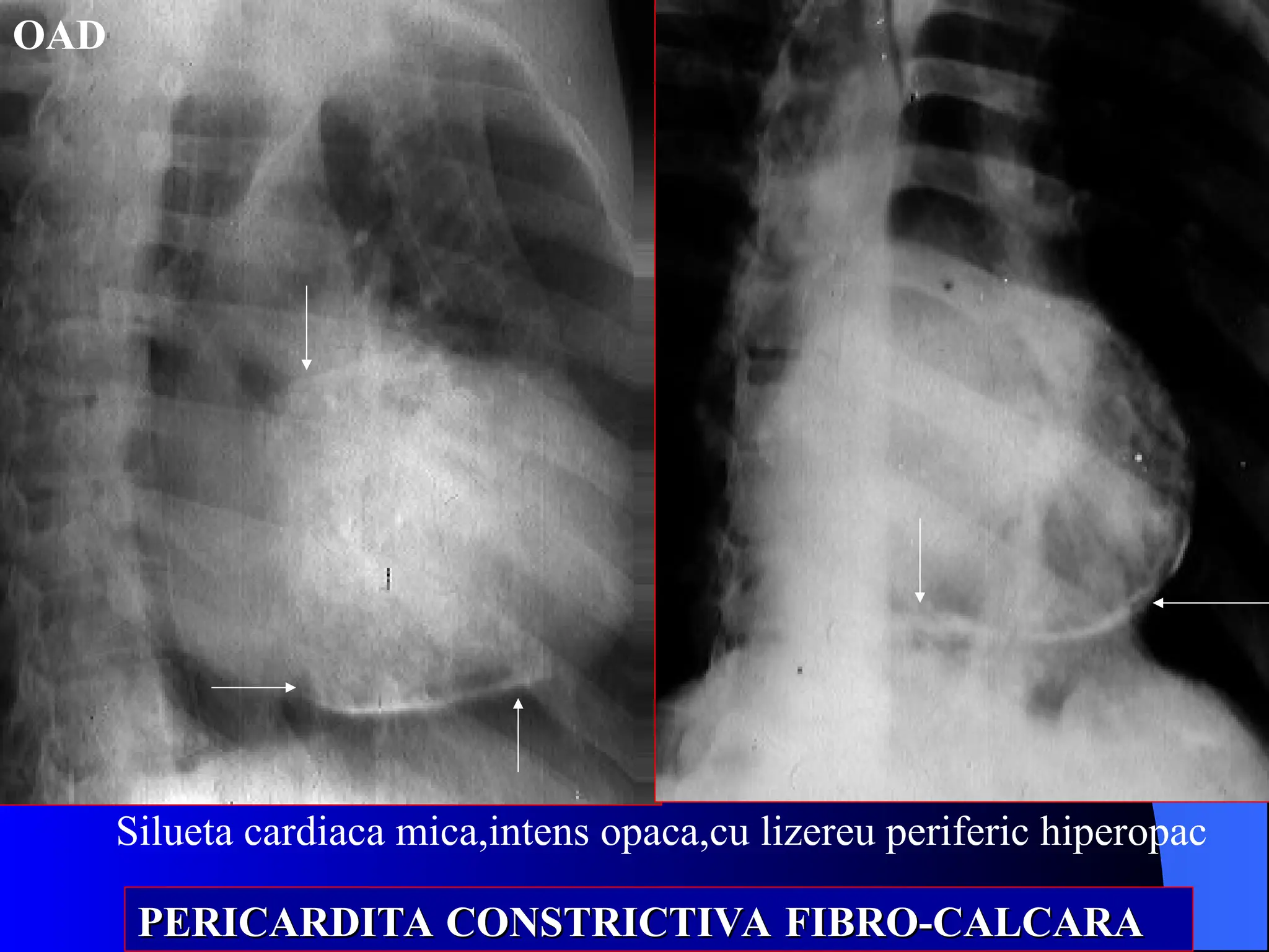 03 - cv - curs 6 - cm-pericardite.ppt.ppt