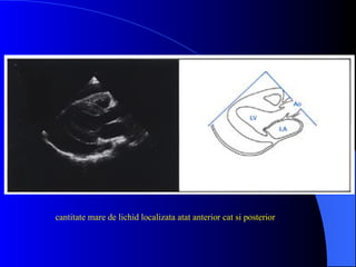 03 - cv - curs 6 - cm-pericardite.ppt.ppt